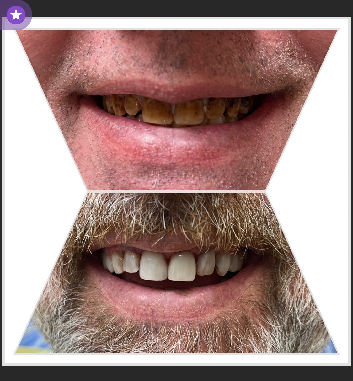 $125 and five visits later - far from excellence in composite but ...