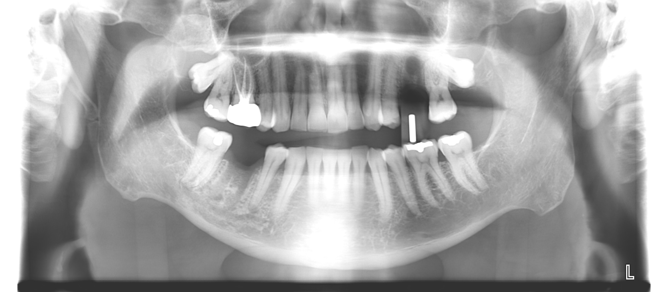 Bilateral maxillary cysts - Spear Talk