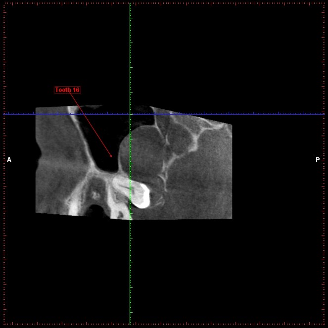 Bilateral maxillary cysts - Spear Talk
