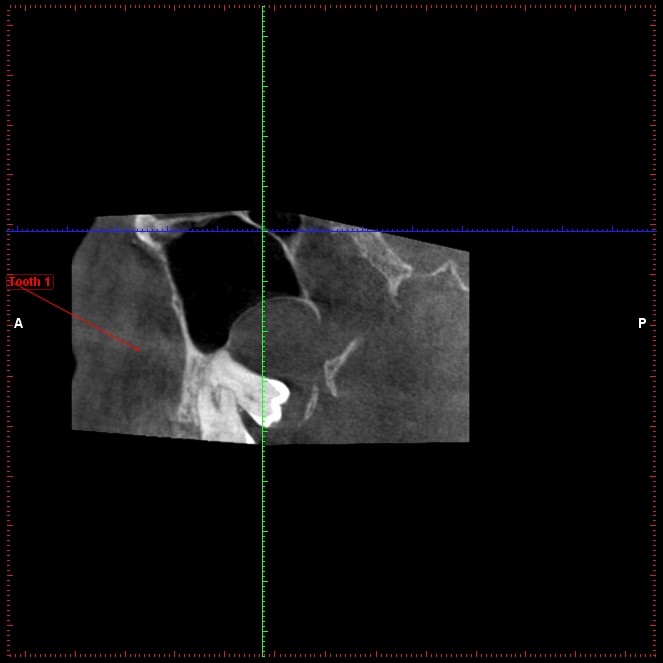 Bilateral maxillary cysts - Spear Talk