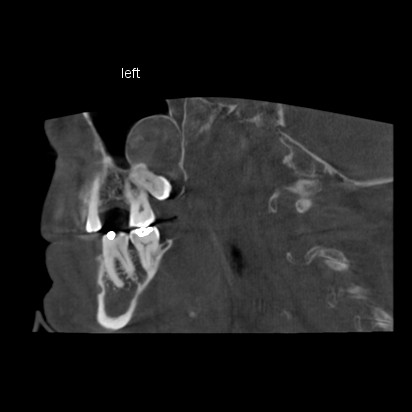 Bilateral maxillary cysts - Spear Talk