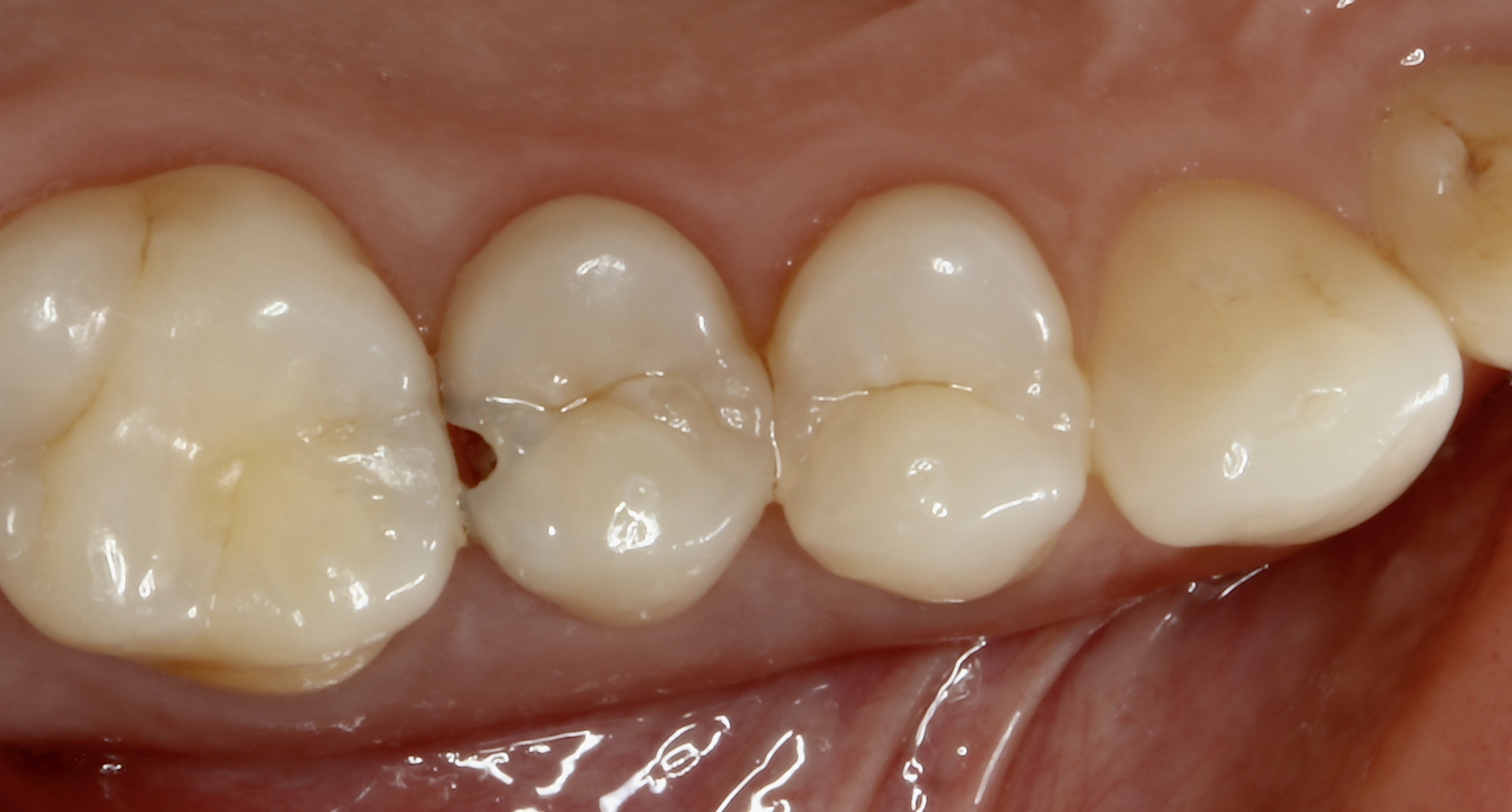 How would you manage deep caries in this case? - Spear Talk