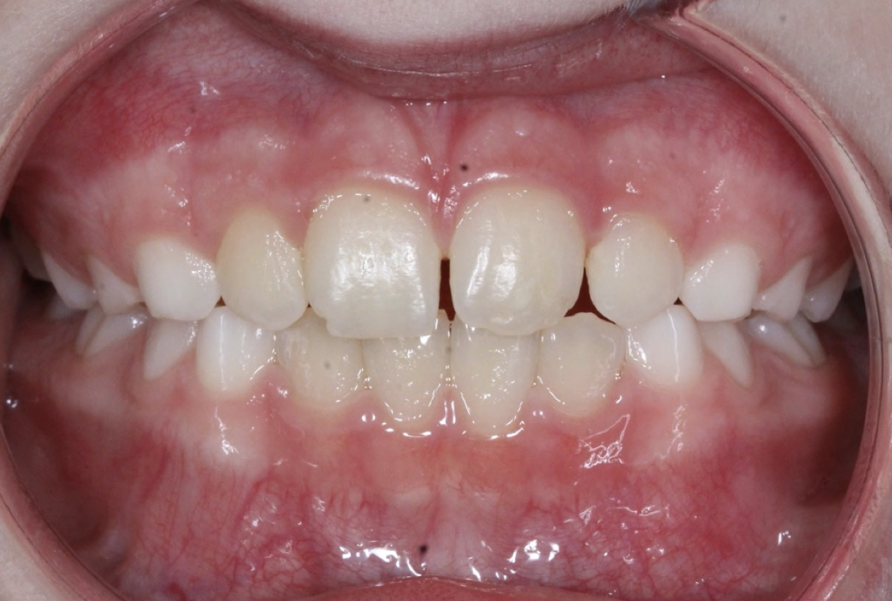 Palatal Canines - Etiology and Conservative Solutions - Spear Talk