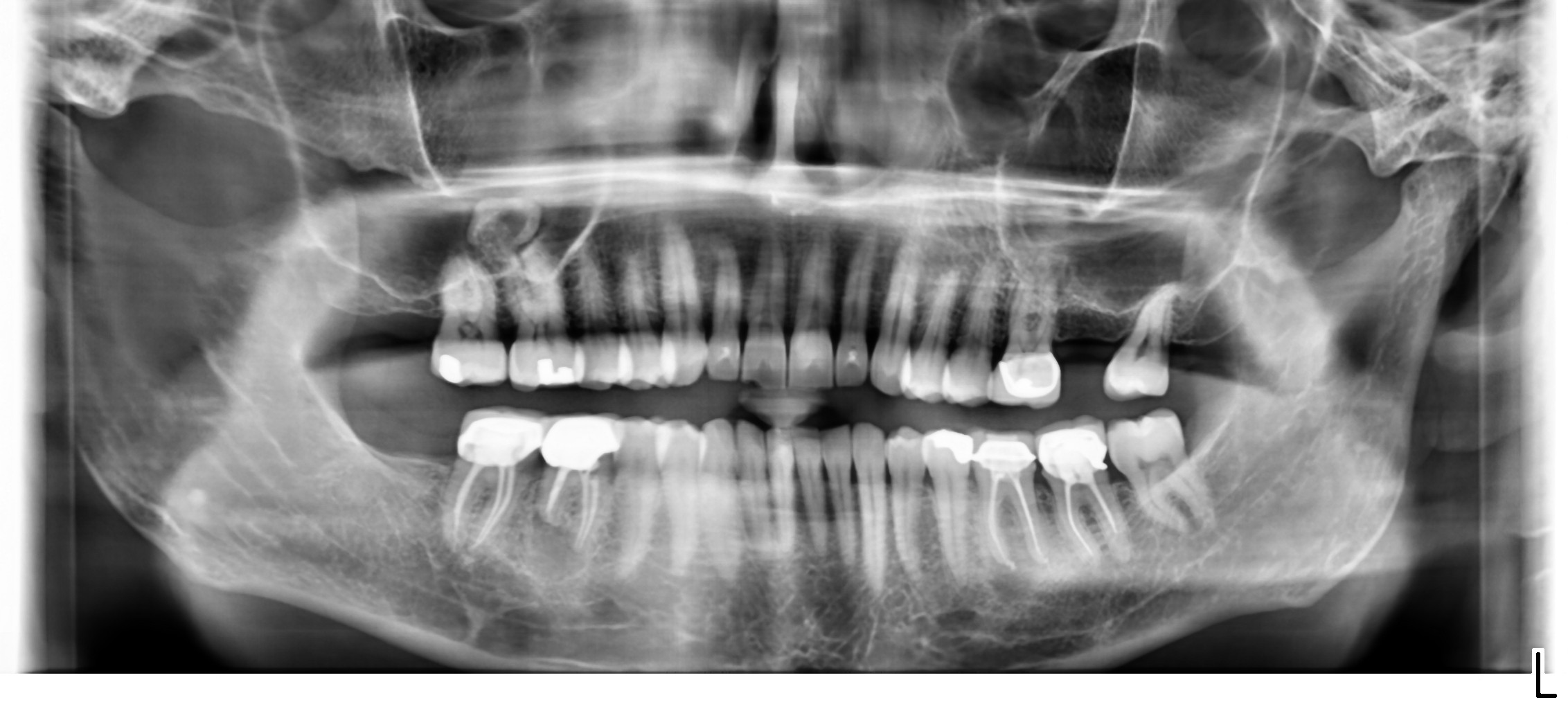 Maxillary sinus exostosis - Spear Talk