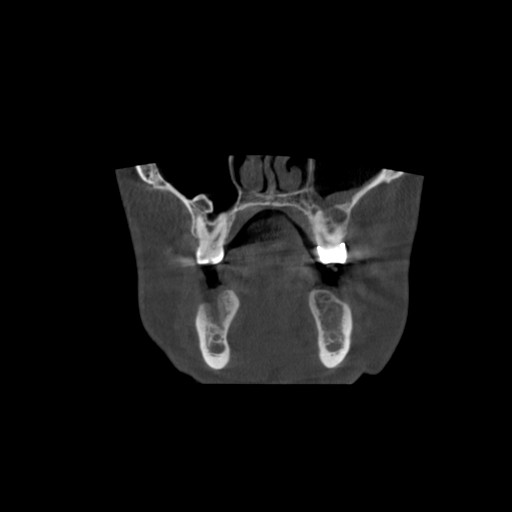 Maxillary sinus exostosis - Spear Talk