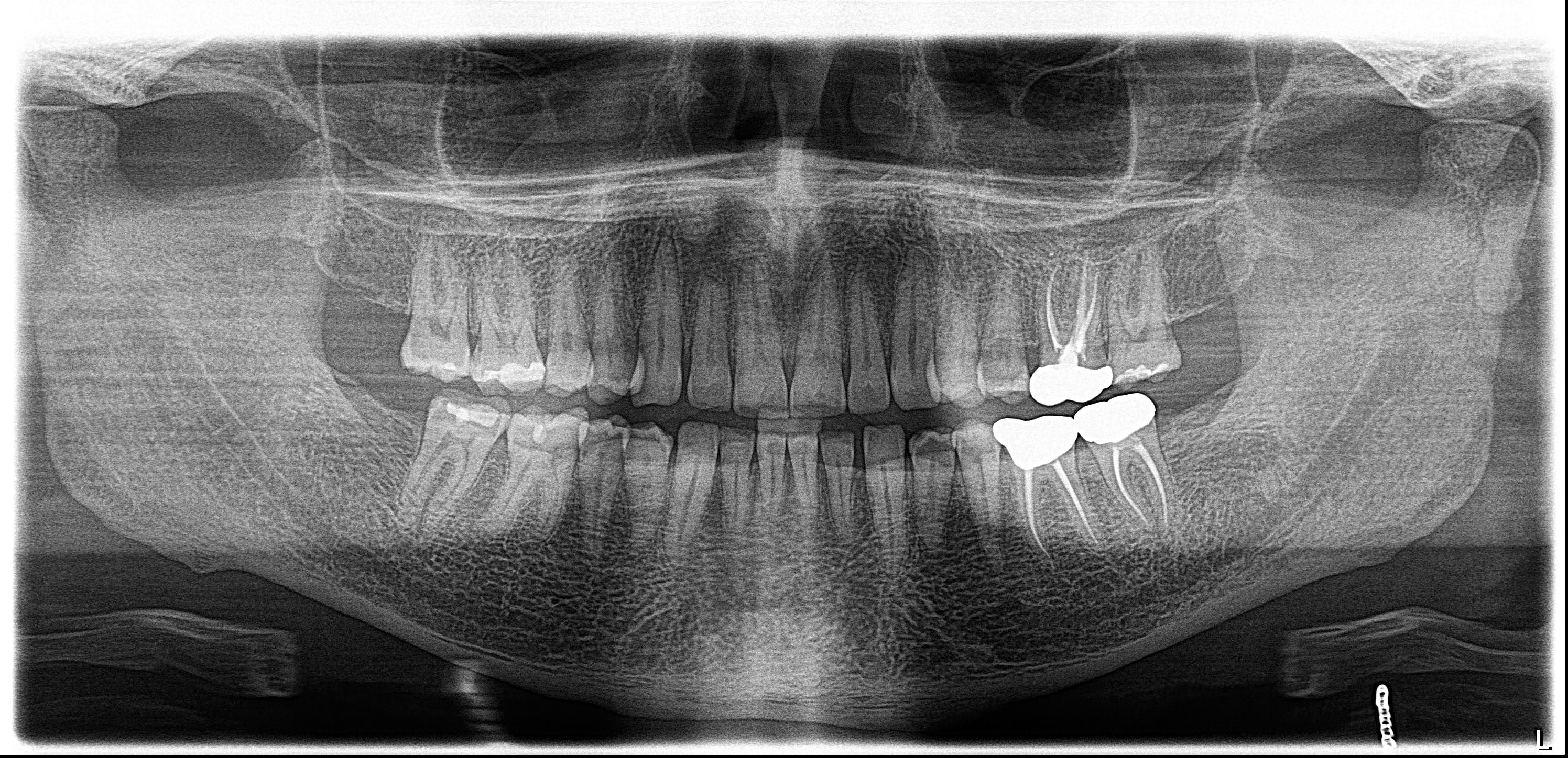 CO/CR slide and Orthodontic treatment - Spear Talk