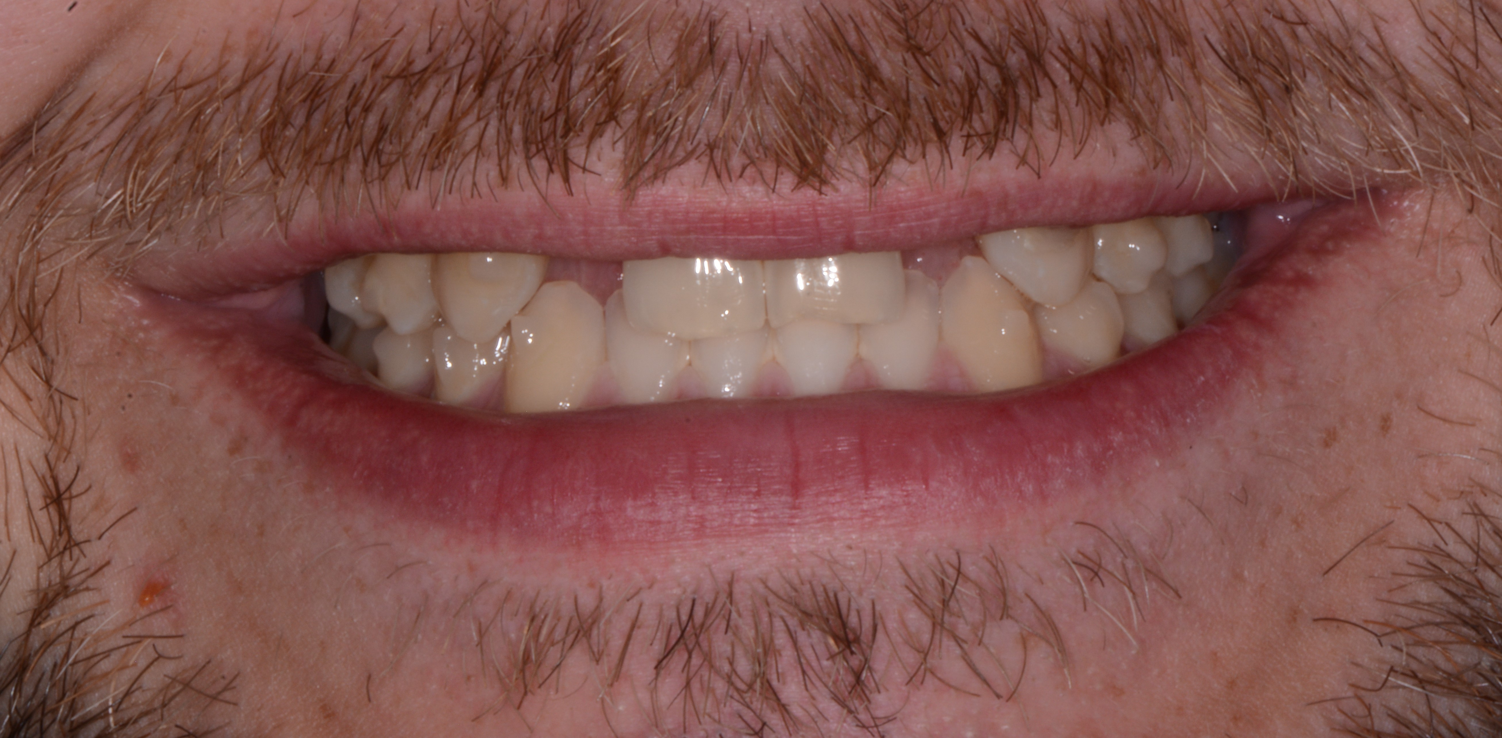 Guided implant surgery for maxillary lateral incisors, temporization - Spear Talk