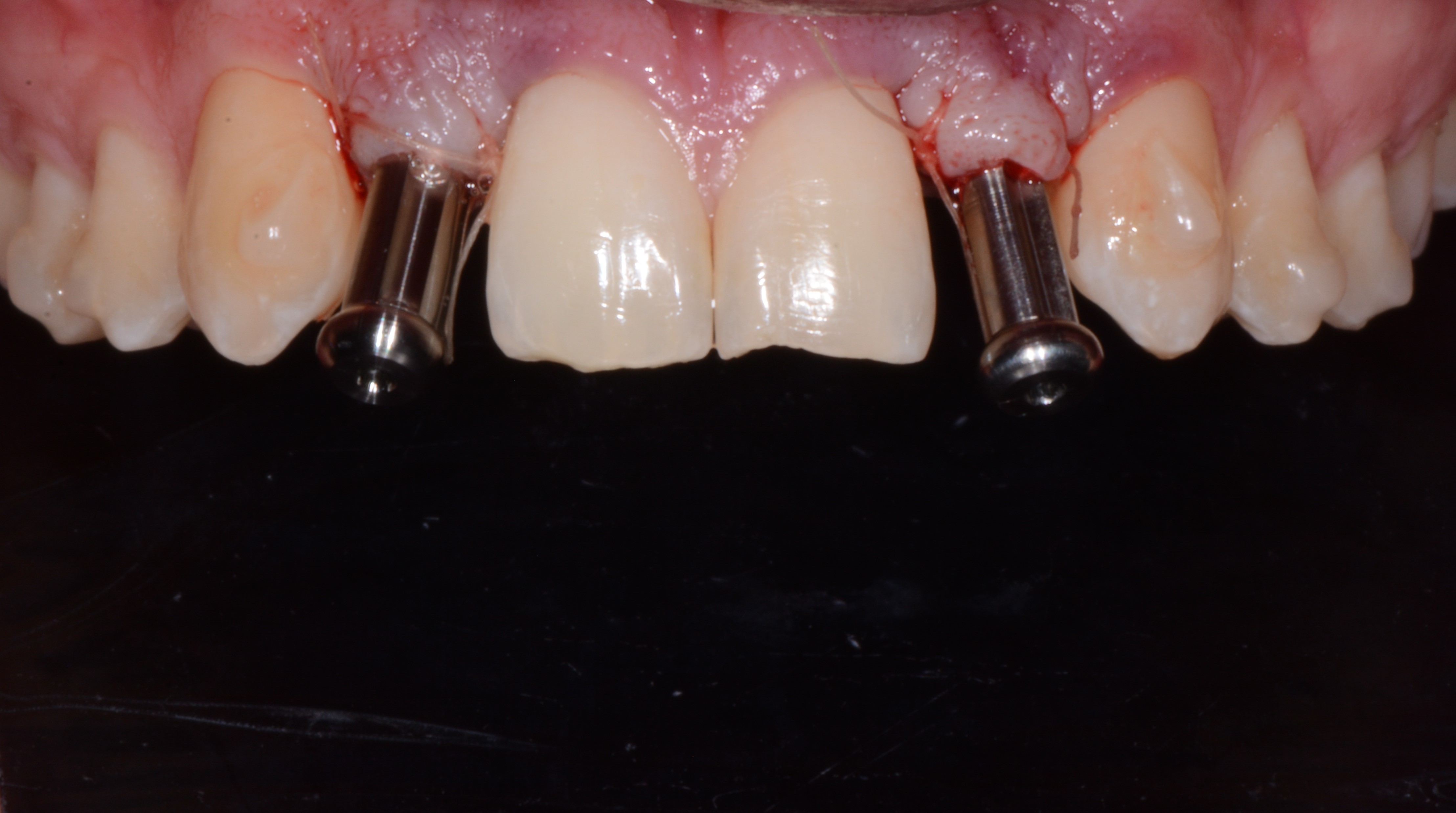 Guided implant surgery for maxillary lateral incisors, temporization - Spear Talk