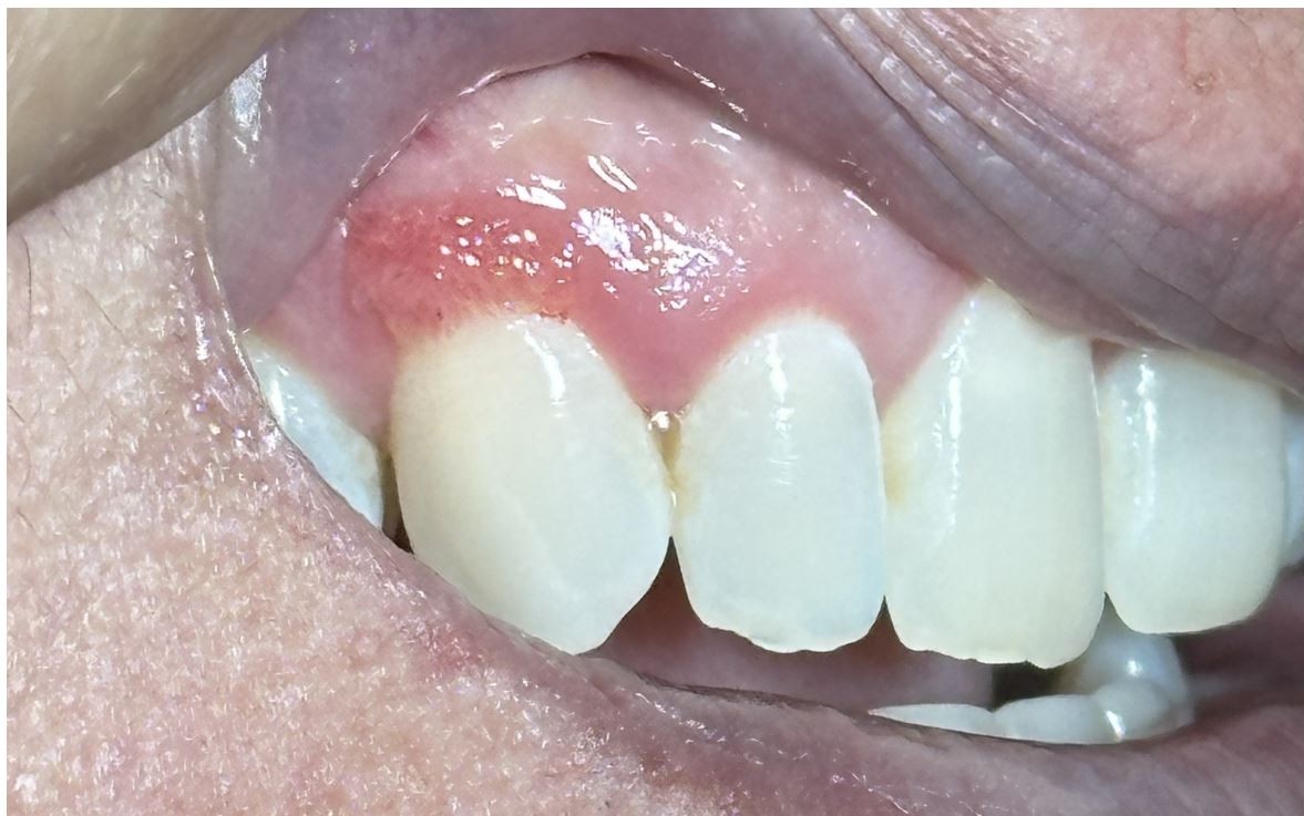 Interesting gingival lesion - Spear Talk