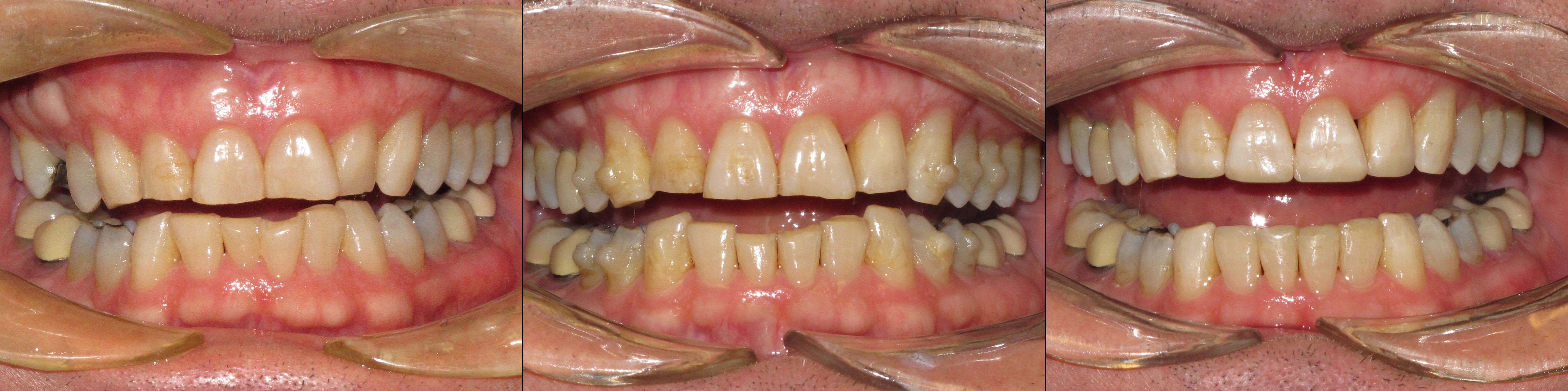 A Case Report ...Non-Surgical Clinical Crown Lengthening - Spear Talk