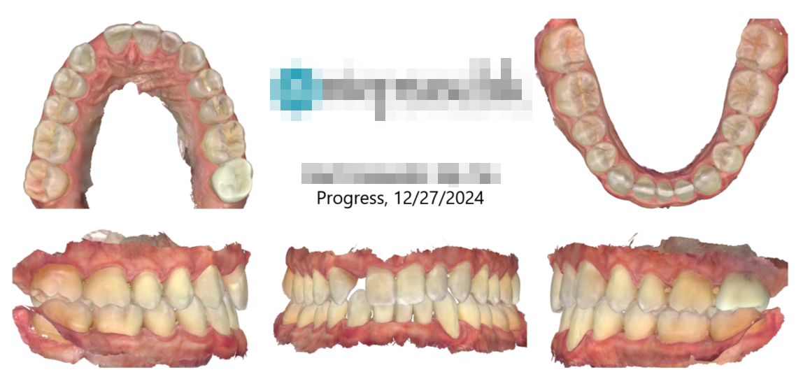 Guidance on restoring 7-10 with implant bridge - Spear Talk