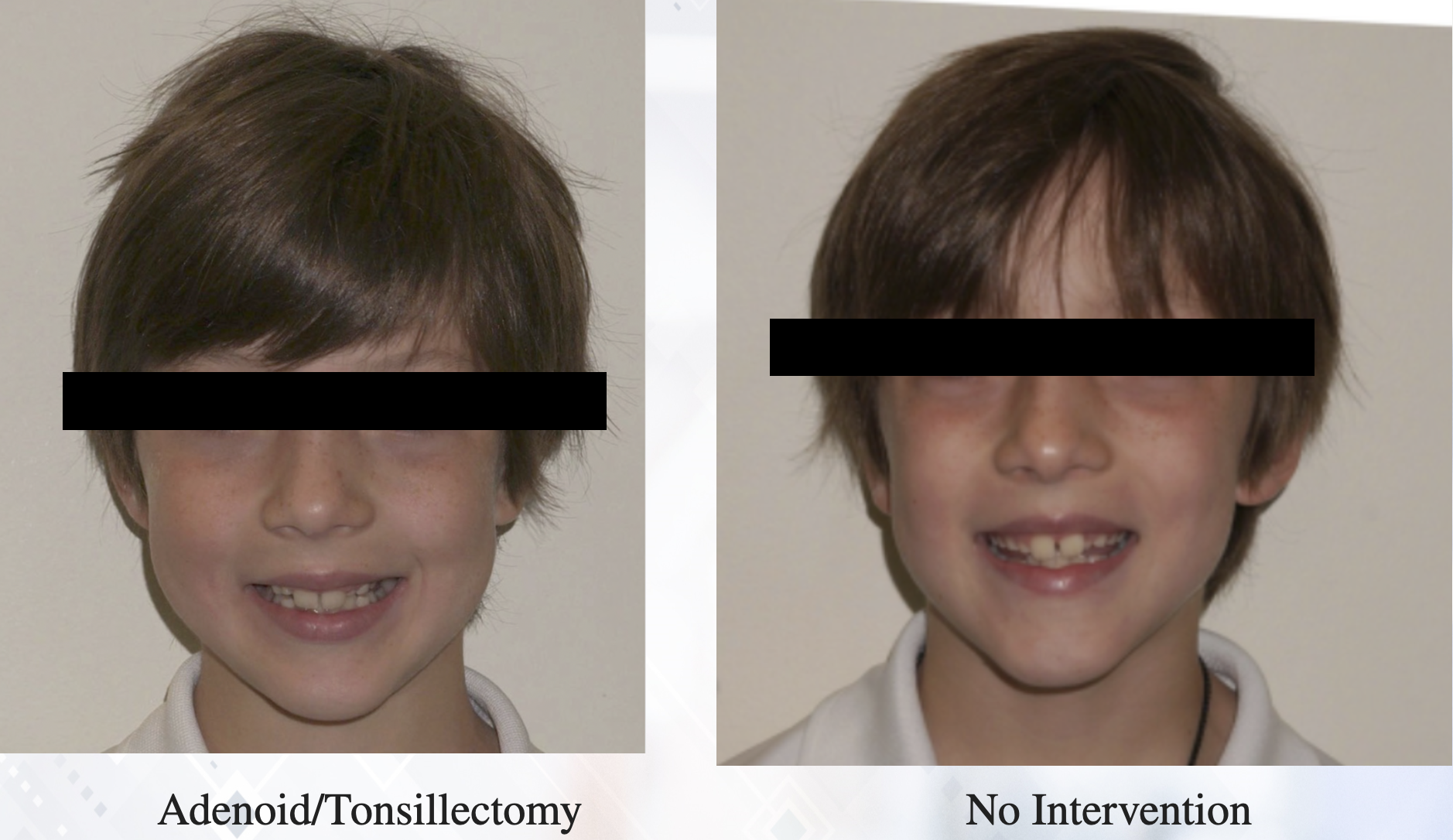 Great example of Adenoids/Tonsils influencing development... - Spear Talk