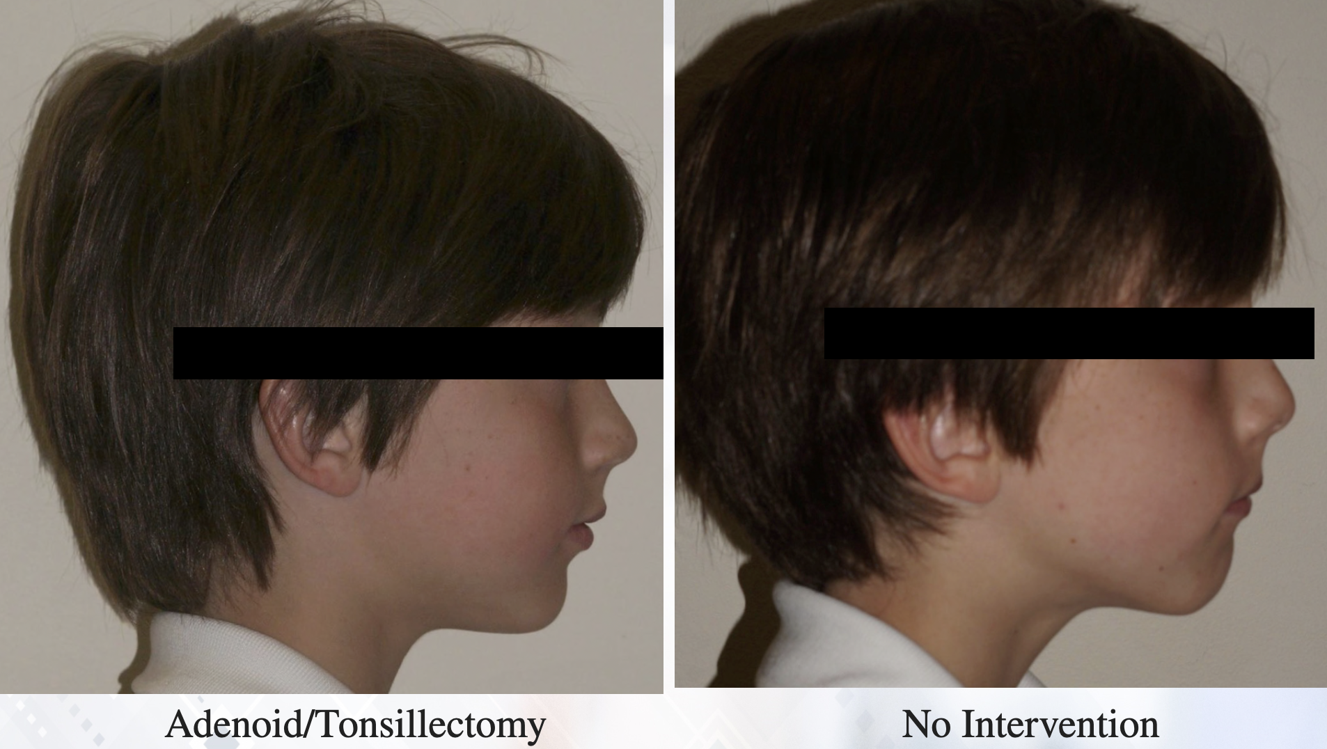 Great example of Adenoids/Tonsils influencing development... - Spear Talk