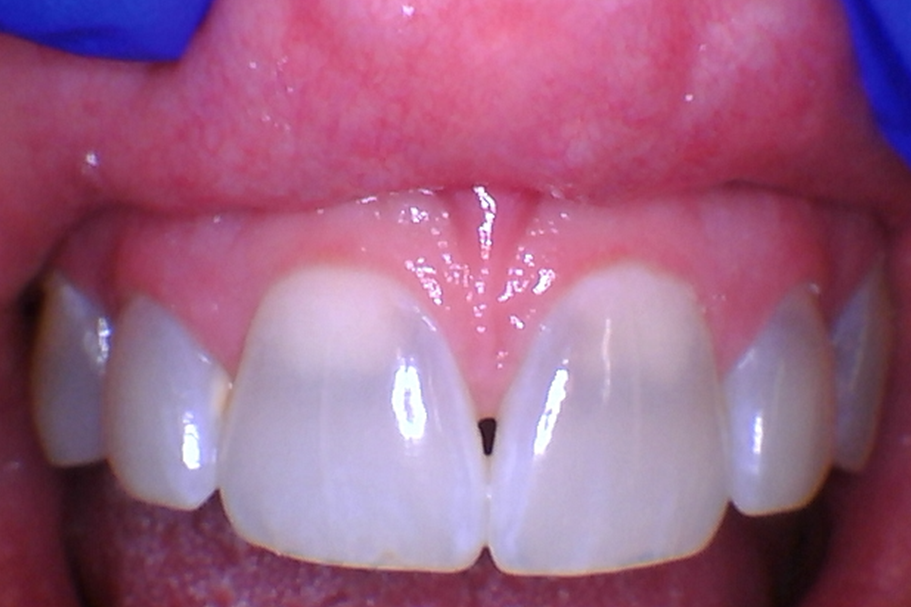 Tooth internal discoloration - Spear Talk