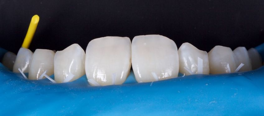 Class 4 Dental Restoration | Step by step for class IV restorations – VJNT