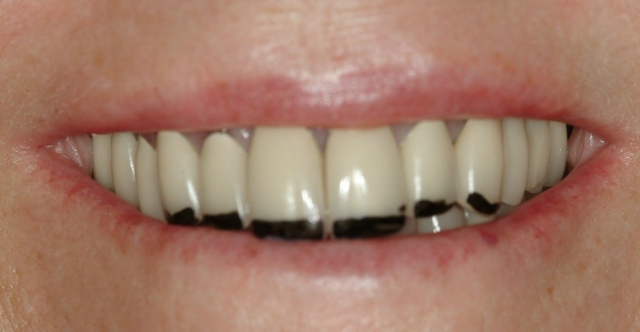 How a Camera and Sharpie Can Improve Dental Case Acceptance - Spear ...