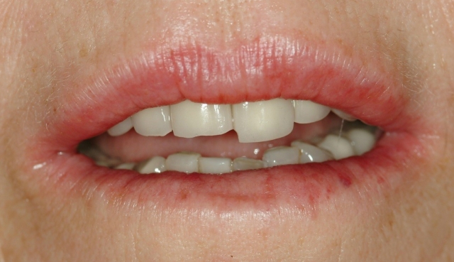 How a Camera and Sharpie Can Improve Dental Case Acceptance - Spear ...