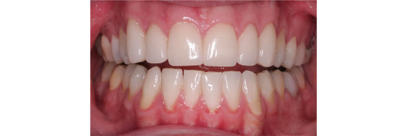 Functional Incisal Edges: Managing the Incisal Guidance - Spear Education