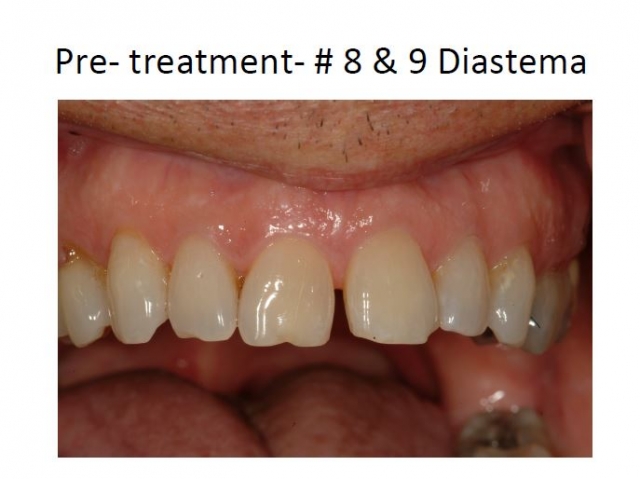 Managing Diastemas With Veneers - Spear Education