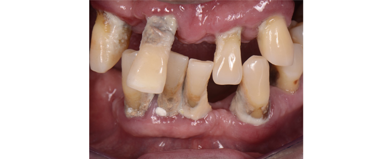 Terminal Dentition: Where Do We Draw the Line? - Spear Education