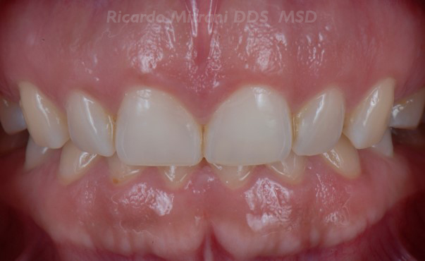 A Step by Step Guide To Virtual Crown Lengthening Spear Education